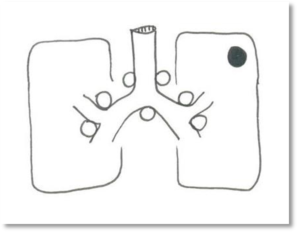 Mediastinal staging ved mistænkt lungecancer – DLS | Dansk ...